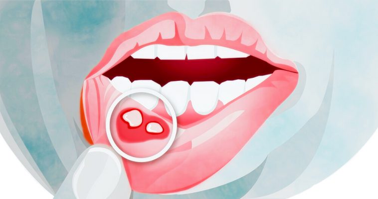 Oral Cancer Symptoms; 13 Signs of Mouth Cancer - Healthella