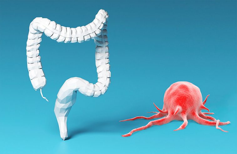 Colon Cancer | Early Warning Signs & Stages of Colon Cancer - Healthella