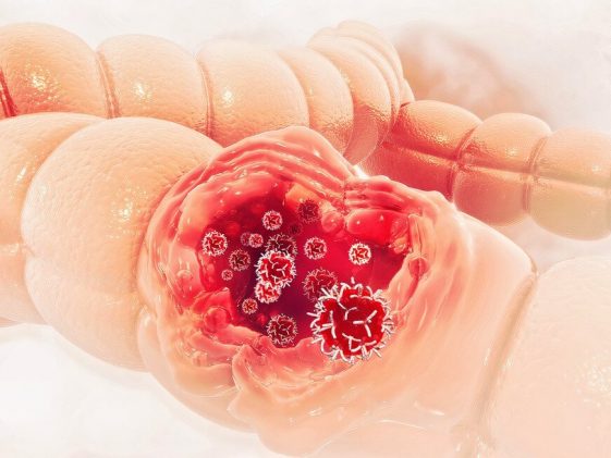 12 Common Signs & Symptoms of Esophageal Cancer You Should Need to Know