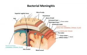 Bacterial Meningitis; Transmission, Symptoms, Treatment & Vaccine ...