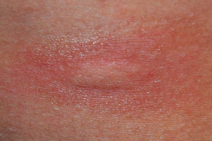 When to Worry about A Rash in Adults? - Healthella