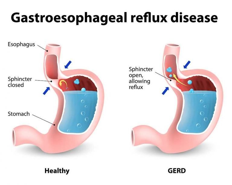 13 Gastroesophageal Reflux Disease (GERD) Warning Signs & Symptoms ...