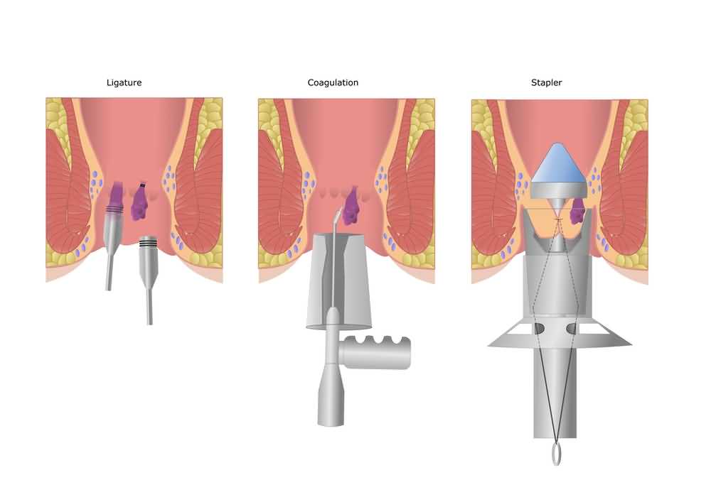 Hemorrhoids Symptoms Causes Diagnosis Treatment Prevention Hemorrhoids Symptoms Causes Diagnosis Treatment Prevention