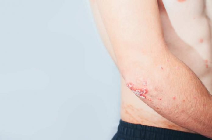 When to Worry about A Rash in Adults? - Healthella