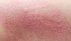 When to Worry about A Rash in Adults? - Healthella