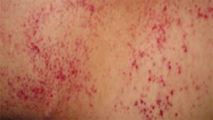 When to Worry about A Rash in Adults? - Healthella