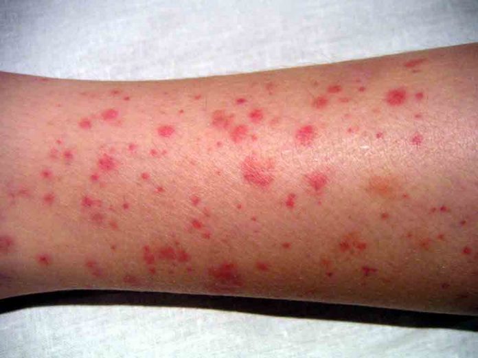 When to Worry about A Rash in Adults? - Healthella