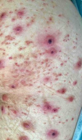 When to Worry about A Rash in Adults? - Healthella