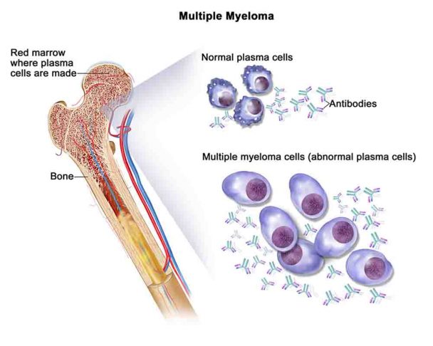 Multiple Myeloma; 14 Multiple Myeloma Symptoms & Multiple Myeloma ...