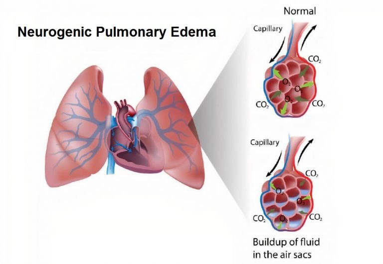 Neurogenic Pulmonary Edema | Causes, Symptoms and Treatment - Healthella
