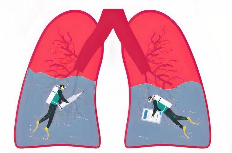 Acute Pulmonary Edema | Symptoms, Causes & Treatment - Healthella