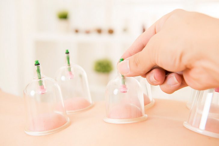 Cupping Therapy | Types, Uses, Benefits, Contraindication & More ...