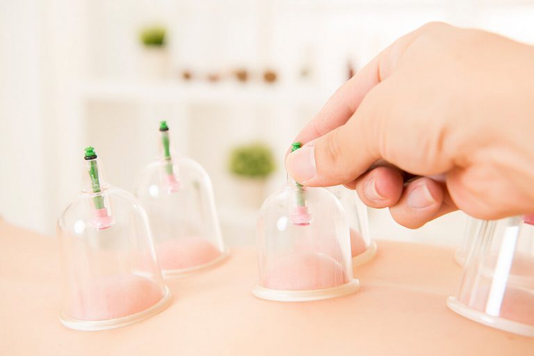 Cupping Therapy | Types, Uses, Benefits, Contraindication & More ...