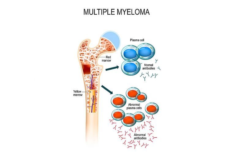 Multiple Myeloma | Types, Causes, Symptoms, Diagnosis & Treatment - Healthella