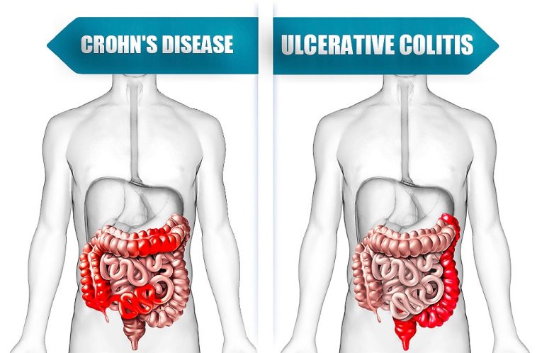 Ulcerative Colitis & Crohn’s Disease | What Are the Differences ...